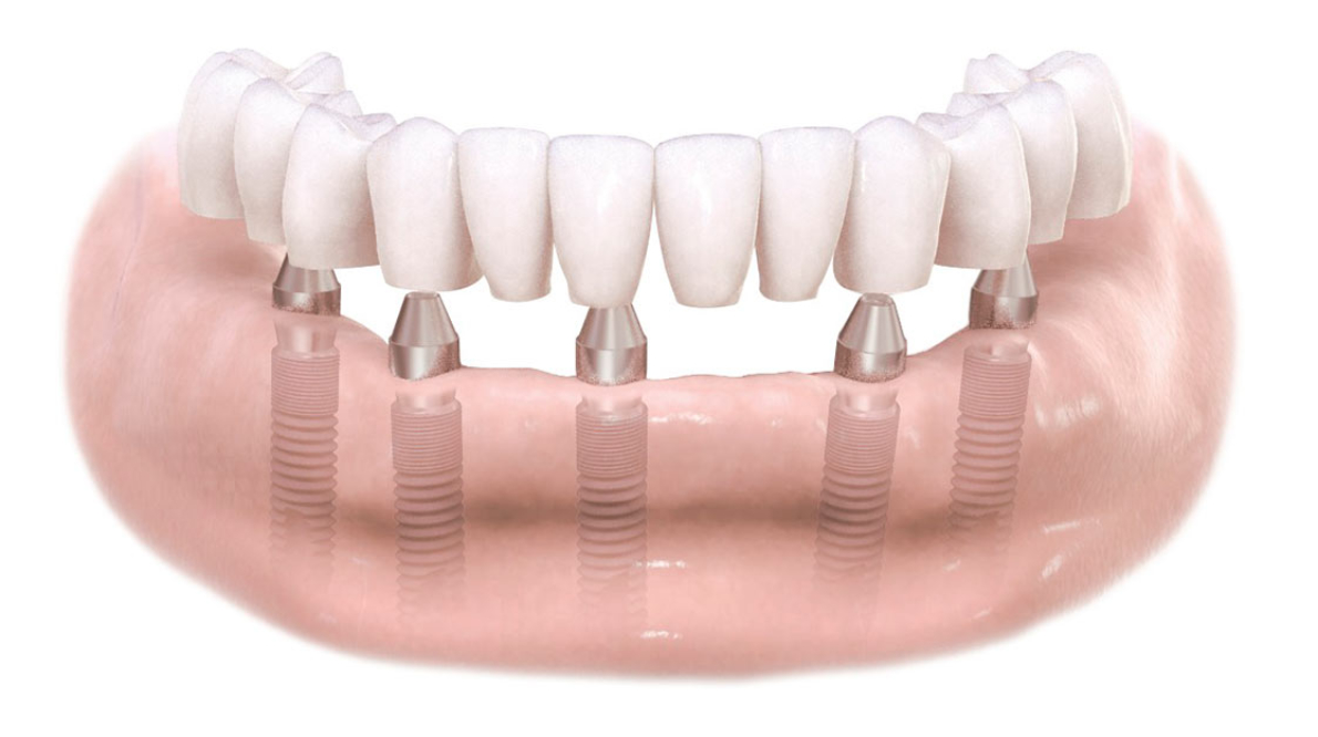 Implantes Unitarios - IMPLANTES DENTALES MADRID | DR. HERNÁN